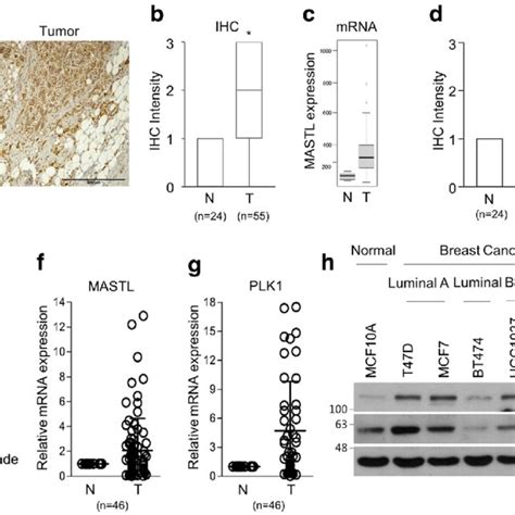 Mastl Is Associated With Tumor Progression In Breast Cancer A