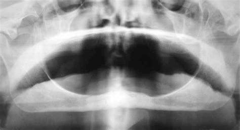 Genial Tubercle X Ray