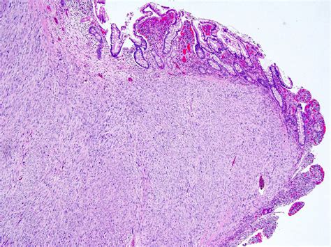 Pathology Outlines Gastrointestinal Stromal Tumor Gist