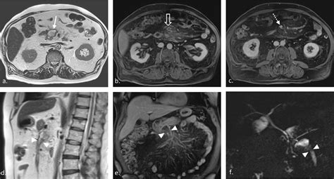Axial T2 Weighted A And Postcontrast T1 Weighted B C Images