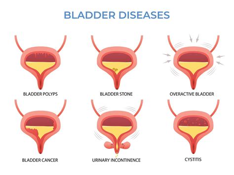 Urology And Urinary System Bladder Diseases 22650186 Vector Art At