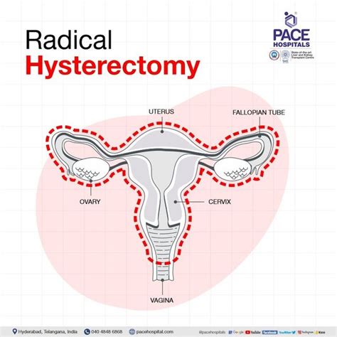 Complete Hysterectomy Surgery Procedure Complete Hysterectomy Surgery Procedure
