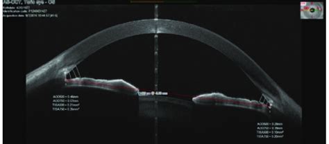 Anterior Segment Oct View With Permission From Cso [2] Download Scientific Diagram