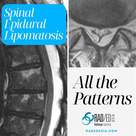 Spinal Epidural Lipomatosis Lumbar And Thoracic Mri Radedasia