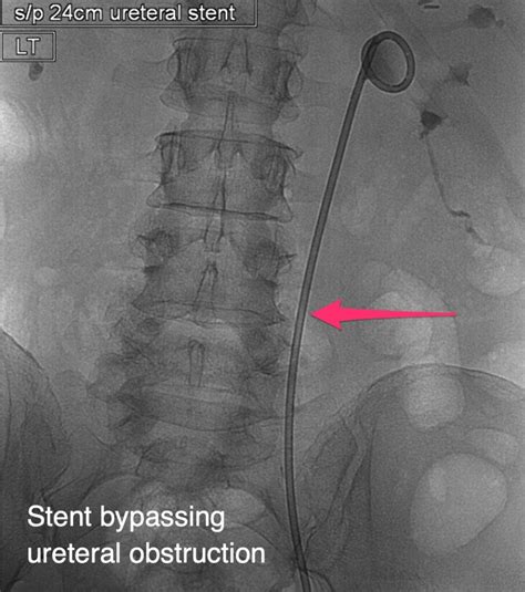 Nephrostomy Location