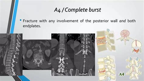 Thoracolumbar Fractures Classification Pptx