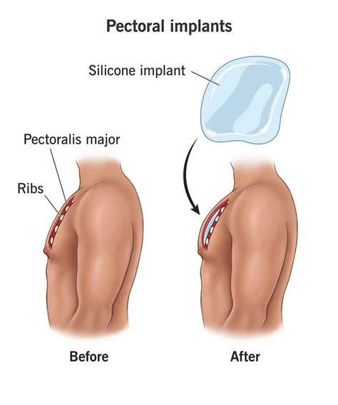 Pec Pectoral Implants Surgery Scars Before And After Wockr