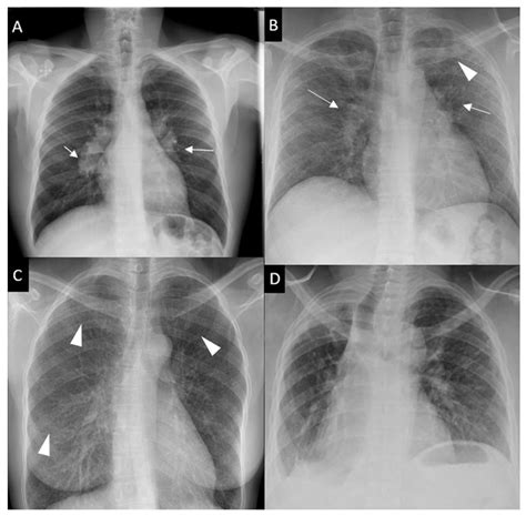 Sarcoidosis A Clinical Overview From Symptoms To Diagnosis
