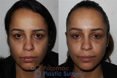 How To Reduce Swelling After Fillers Potomac Plastic Surgery