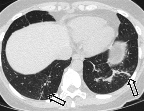 Lower Lobe—predominant Diseases Of The Lung Ajr