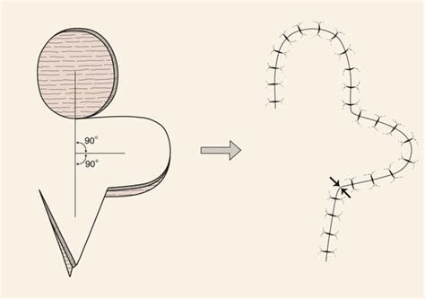 Flap Classification And Design Plastic Surgery Key