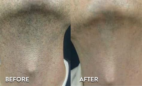 Laser Hair Removal Before And After Pictures Atlanta Ga