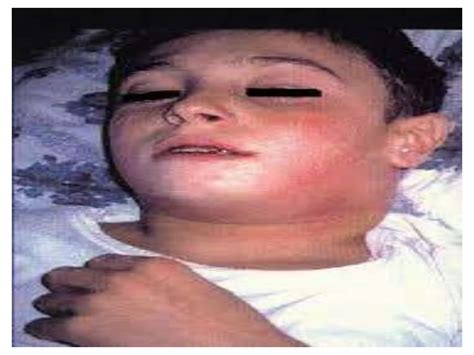 Acute And Chronic Pharyngitis Pptx