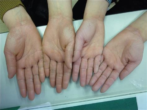 Hereditary Papulotranslucent Acrokeratoderma A Simultaneous