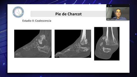 Pie De Charcot Diagnóstico Y Manejo En Fase Aguda Youtube