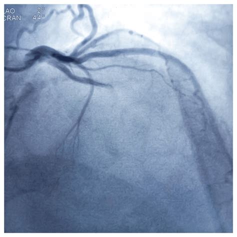 1171 Coronary Angiogram Images Royalty Free Photos And Stock Images