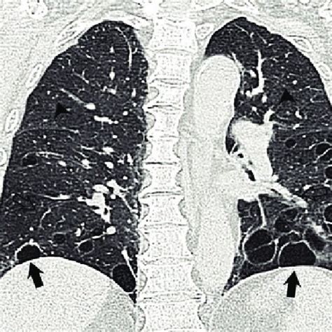 Typical Hp Nonfibrotic Pattern Axial Hrct Shows Diffuse Centrilobular Download Scientific