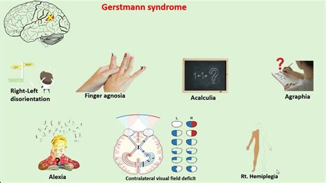 Gerstmann Syndrome Alexia With Agraphia Angular Gyrus Youtube
