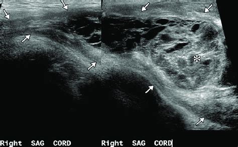 Postoperative Hematoma In A 45 Year Old Man With Scrotal Swelling And Download Scientific