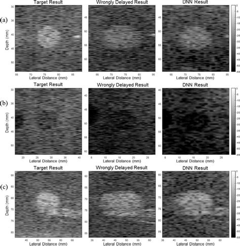 Deep Learning For Ultrasound Beamforming In Flexible Array Transducer Pmc