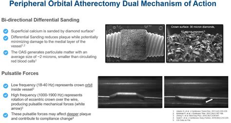 Orbital Atherectomy Treatment Of Peripheral Artery Disease And Critical