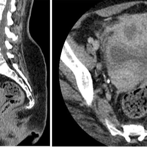 Abdominal Ct Showing A Midline Suprapubic Mass Of Heterogeneous