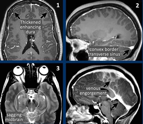 什么是自发性低颅压？ 知乎