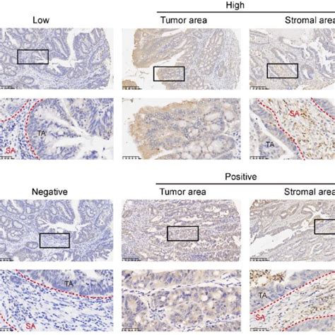 Siglec15 And Pd L1 Expression In Coad Cancer Samples Representative Download Scientific