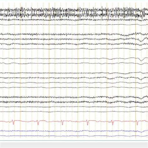 Electroencephalogram Eeg Showing Diffuse Encephalopathy Download Scientific Diagram