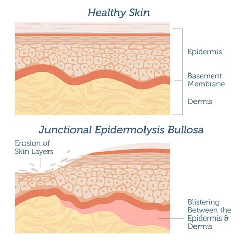 Junctional Epidermolysis Bullosa Genebase