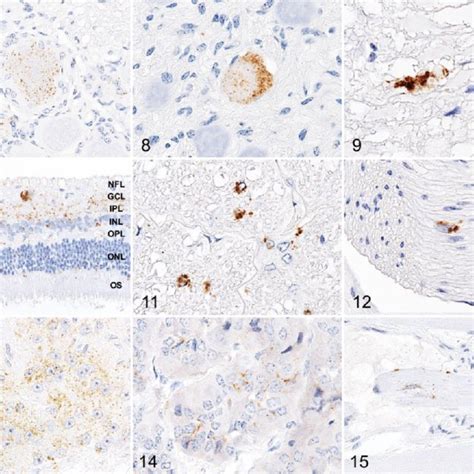 Disease Associated Prion Protein Prp Sc Deposits Extracerebral