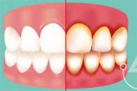 Healthy Gums Vs Gingivitis