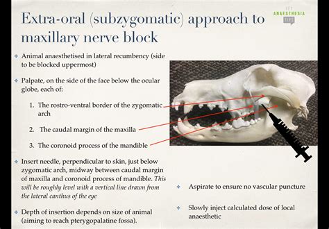 Maxillary Nerve Block Technique