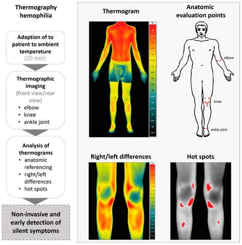 Infrared Thermography As A Non Invasive Tool To Explore Differences In The Musculoskeletal