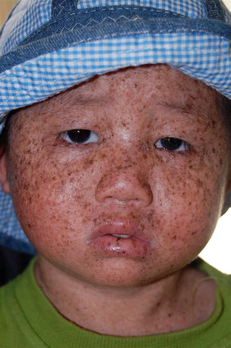 Xeroderma Pigmentosum Pictures Symptoms Treatment And More