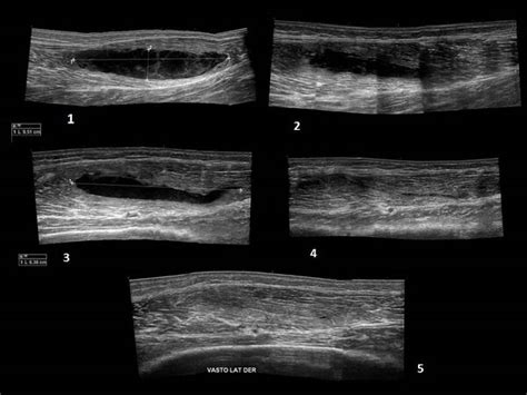 Quadriceps Contusion Wikism Sports Medicine Wiki
