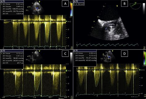 A Increased Transvalvular Gradient In Setting Of Obstructive