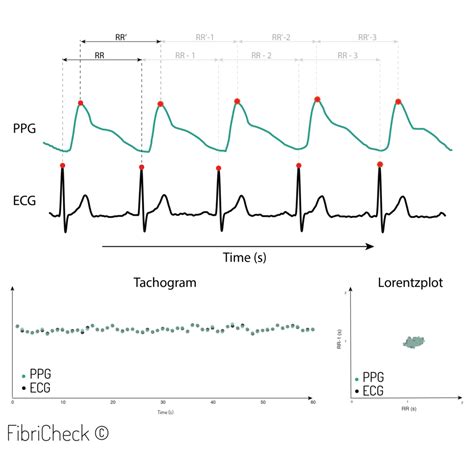 Fibricheck Beat To Beat Accuracy Compared With Wearable Ecg In Broad