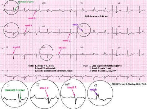 A 12 Lead Ecg Lbbb Vs Rbbb Mnemonic Using Heart