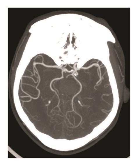 Axial Cerebral Cta Image Showing Bilateral Fetal Pca With Right P1