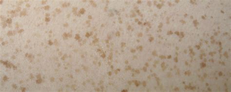 Mimics Of Skin Cancer Flashcards Quizlet