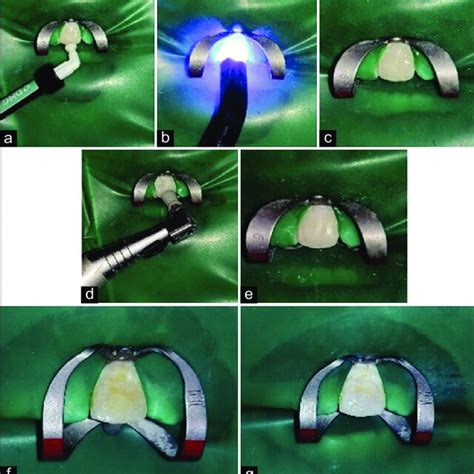 Resin Infiltration Procedure In Tooth 11 A Rubber Dam Isolation Of Download Scientific