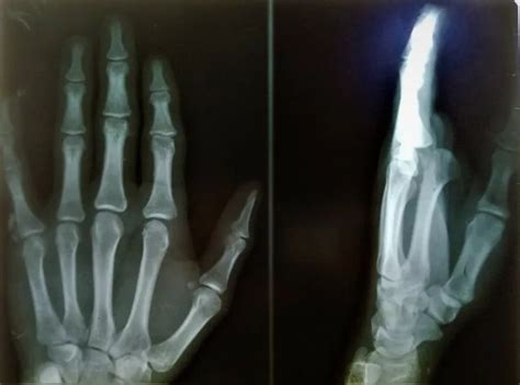 Dislocated Finger Understanding And Treating The Injury