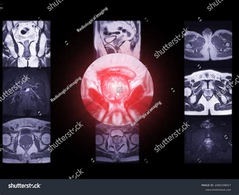 Mri Prostate Gland Revealing Enlarged Size Stock Illustration