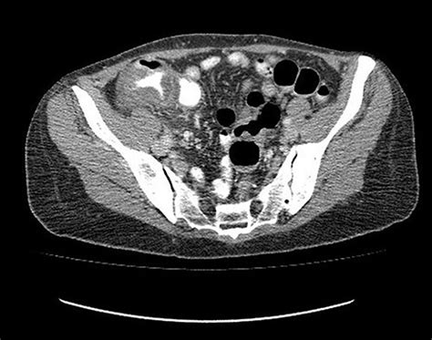 Post Polypectomy Syndrome—a Rare Complication In Colonoscopy Procedures Post Polypectomy Syndrome—a Rare Complication In Colonoscopy Procedures