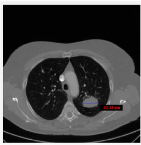 Outline Of Nodule Extraction Process Based On Shape And Intensity Download Scientific Diagram