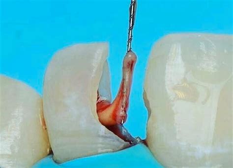 El Corazón Del Diente ¿qué Es La Pulpa Dental Ortounión