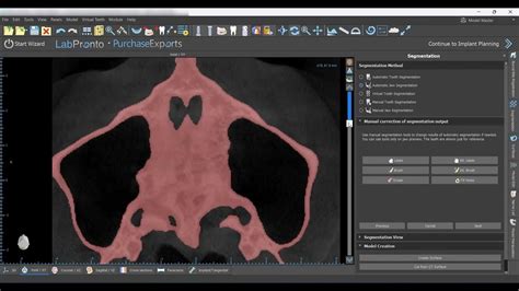 Ai Driven Automatic Bone Segmentation In Blue Sky Plan Youtube