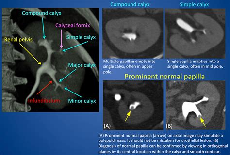Renal Papilla