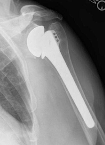 Glenoid Component Clinical Tree